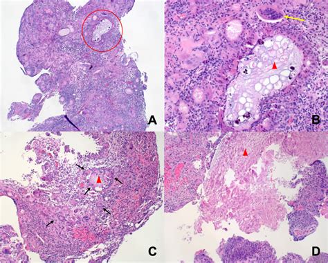 Large Douglas Abscess With Distinctive Bilateral Sal Pingitis In A You