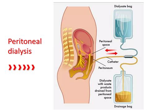End Stage Of Renal Disease Esrd Pptx
