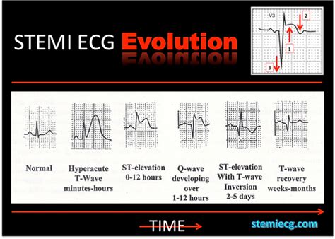 Mastering Stemi Ecg
