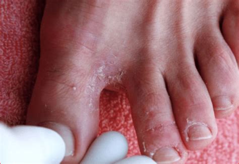Fungus Foot Symptoms Prevention And Those At Risk Greener Health