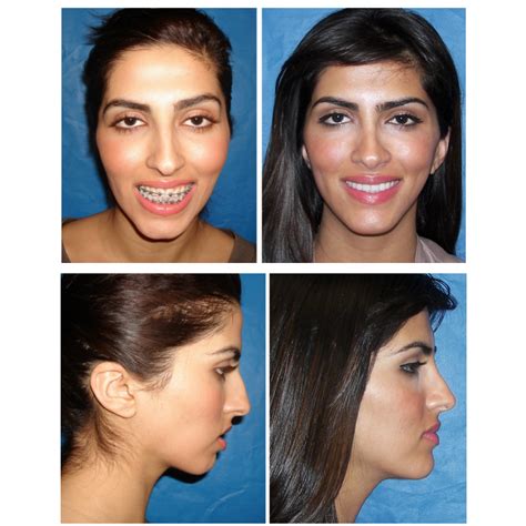 Before And After Surgery Photos Dr Larry M Wolford Dmd
