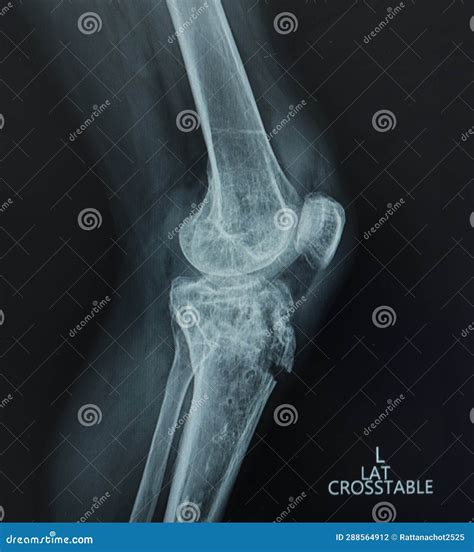 X Ray Left Knee Lateral View Avulsion Fracture Tibial Tubercle Medical Image Concept Stock