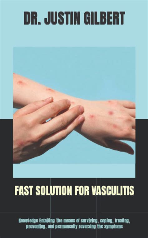 Fast Solution For Vasculitis Knowledge Entailing The Means Of Surviving Coping Treating