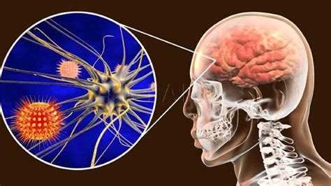 Un Hongo Originó El Brote De Meningitis Aséptica En Durango Que Ha