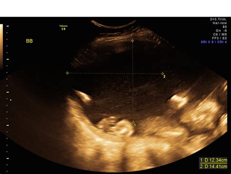 Twin Twin Transfusion Syndrome Ttts Obstetrics And Gynecology