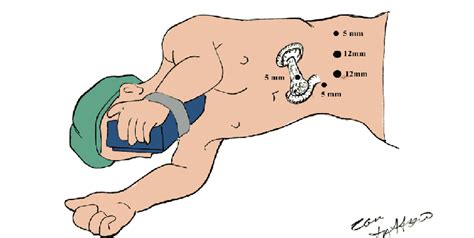 Trocar And Patient Position In Laparoscopic Distal Pancreatectomy Download Scientific Diagram