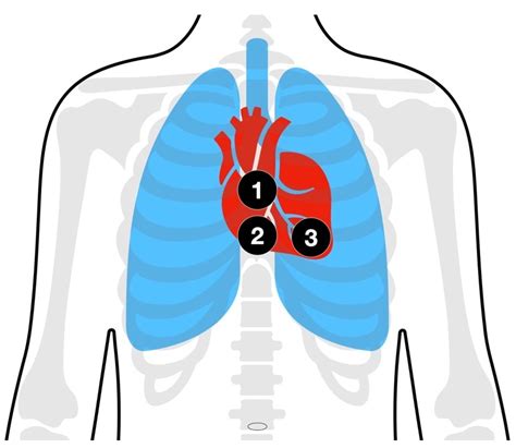 Clamshell Thoracotomy