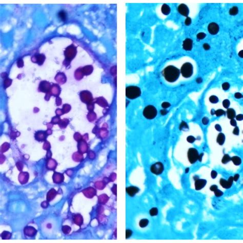 Photomicrograph Of Lymph Node Biopsy Showing Variably Sized Budding