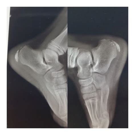 Tankeng Leonard Tanko Md On Linkedin Rare Case Of Severs Disease