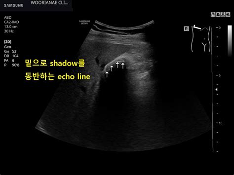 담낭을 꽉 채운 담석 Wall Echo Shallow Complex 의 확인 수시간씩 반복되는 명치 통증으로 담도담낭 폐쇄