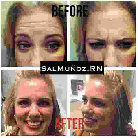 Botox Before And After Face 4 Facelift Info Prices Photos