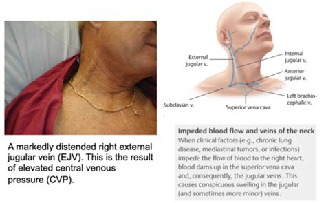 Peripheral Vascular Flashcards Quizlet