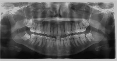 Lifetime Dental Care Wisdom Teeth Lifetime Dental Care