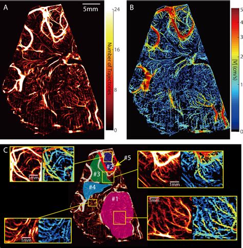 Cerebral Microcirculation In Infantile Hydrocephalus Laboratory For Experimental Fluid Dynamics