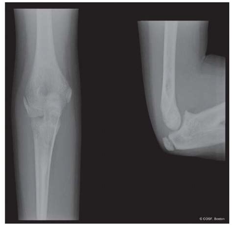 Radioulnar And Metacarpal Synostosis Musculoskeletal Key