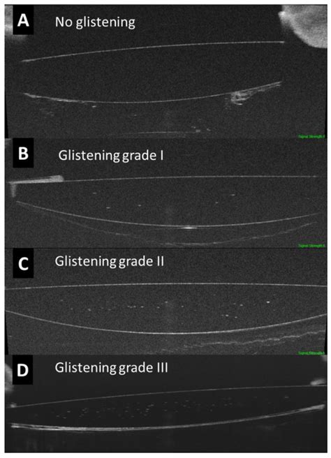 Optical Coherence Tomography Of The Optic Of The Intraocular Lens Iol Download Scientific