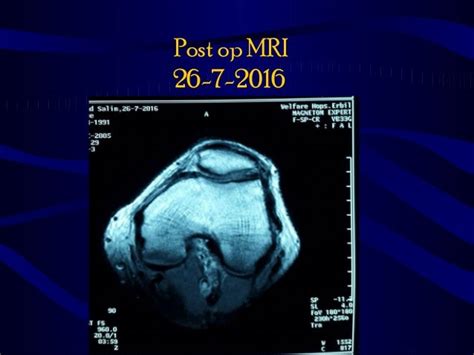 Lateral Patellar Compression Syndrome