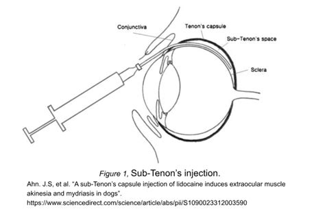 The Sub Tenon Block Technique Advantage And Complications The