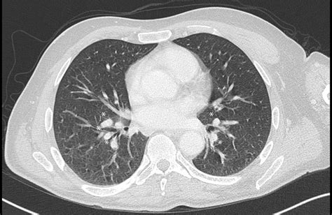 Axial Chest Ct Scan Showing Bilateral Hilar Adenopathy Asterisks