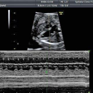 Fetal Ultrasound Power Doppler Measuring The PR Interval As Part Of A Download Scientific