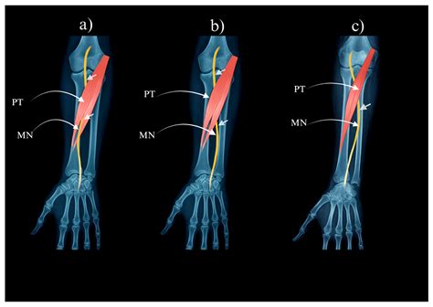 The Pronator Teres Muscle Revisited Morphological Classification