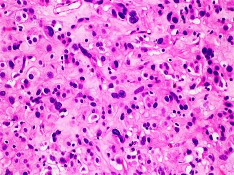Epithelioid GIST