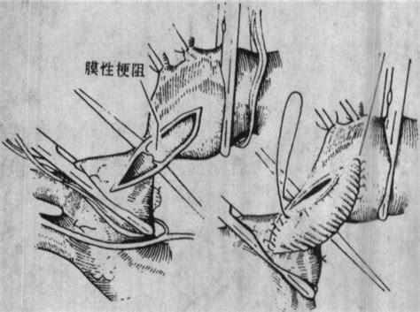 人造血管片主动脉成形术 心脏外科手术