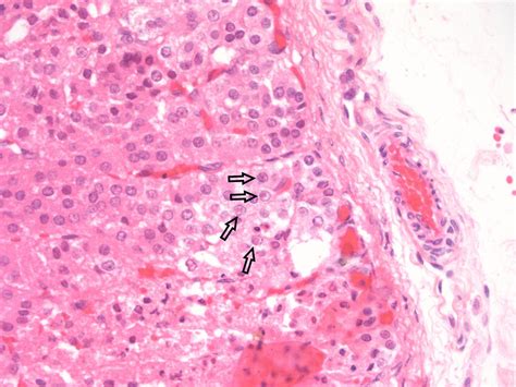 Fatal Congenital Hsv Infection In A Newborn Cortical Adrenal Cells