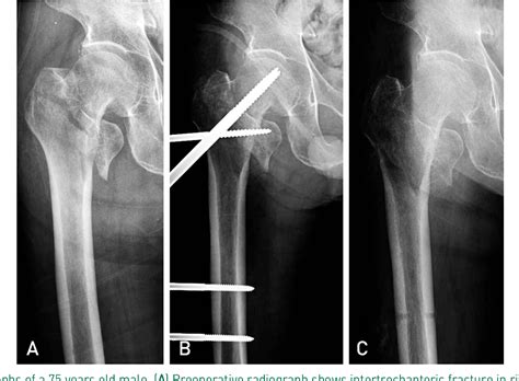 Figure 1 From External Fixation Under Local Anesthesia In