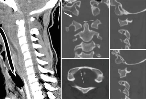 Spine Trauma Radiology Key