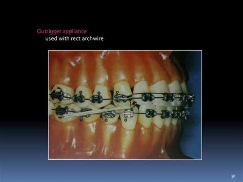 Tip Edge Orthodontics Stage Iii