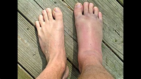 Fracture Broken Ankle Sprain