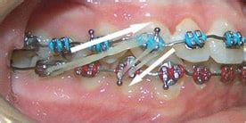 All About Orthodontic Elastics Archwired