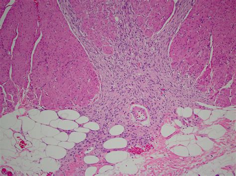 Pathology Outlines Gastrointestinal Stromal Tumor