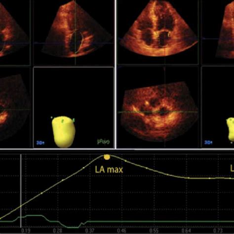 Representative Photos Of The Different Stages Of Retinopathy In The
