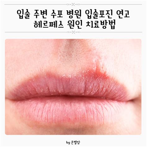 입술 주변 수포 병원 입술포진 연고 헤르페스 원인 치료방법 네이버 블로그