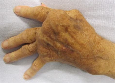 Rheumatoid Arthritis Ulnar Deviation Caption Update