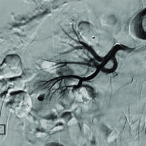 Super Selective Renal Embolization Of A Right Renal Pseudoaneurysm