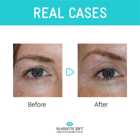 Non Surgical Brow Lift Using A Thread Skinqure
