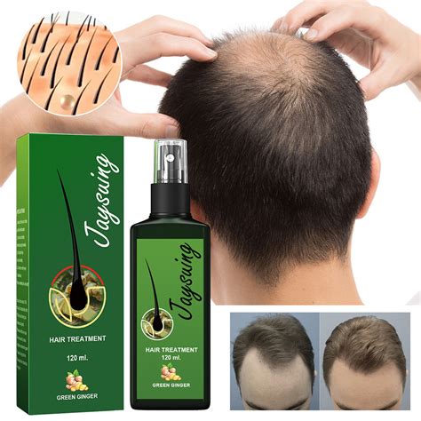 120ml Hair Growth Treatment Anti Hair Loss Promotes Thicker Stronger