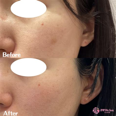 シミ取りピコスポット まゆりなclinic名古屋栄