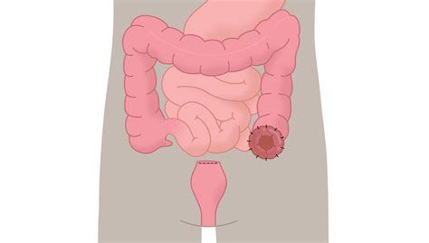 Colostomy