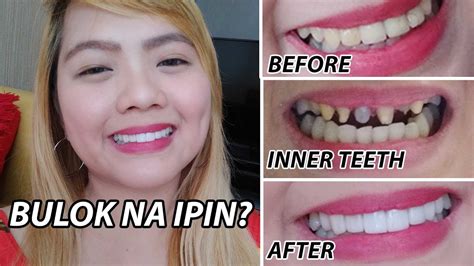 Paputiin Ang Iyong Mga Ngipin Gamit Ang Natural Na Paraan Na Makikita