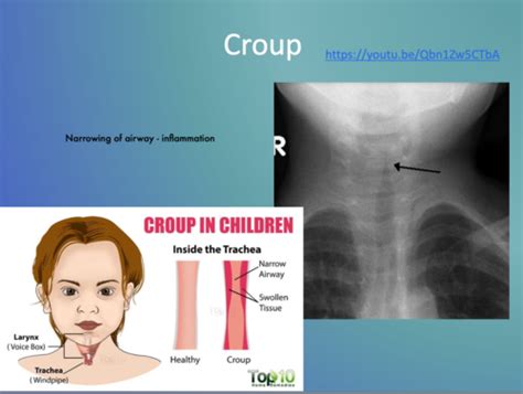 Ch Respiratory Emergencies Flashcards Quizlet