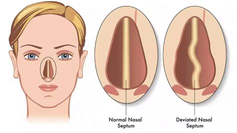 Broken Nose Surgery How To Fix A Broken Nose
