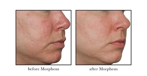 Morpheus8 And Microneedling Rf Cosmetic Skin And Laser Center