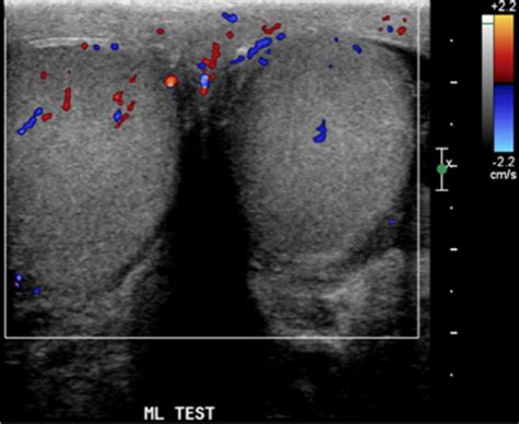 Intermittent Testicular Torsion