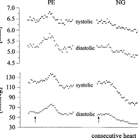 Carotid Distension Waveforms As Recorded In Subject A In Fig 4 At
