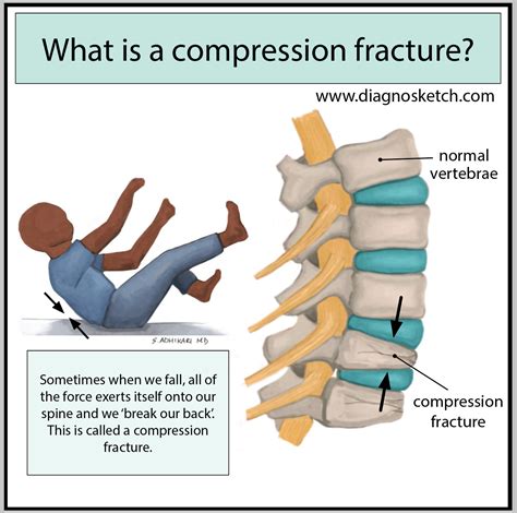 Compression Fracture Gp At Curtis Dolan Blog