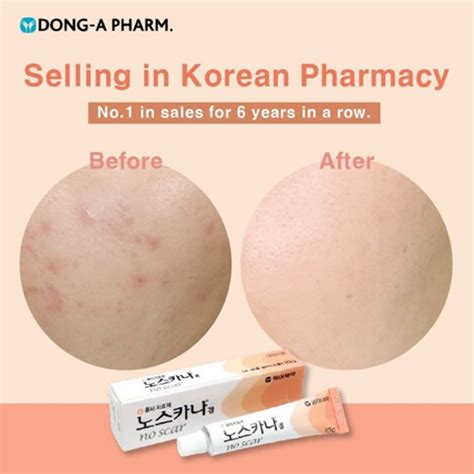 Korean High Quality Noscarna Scar Gel Treat Keloid Surgery Acne Scars Hypertrophic Keloids